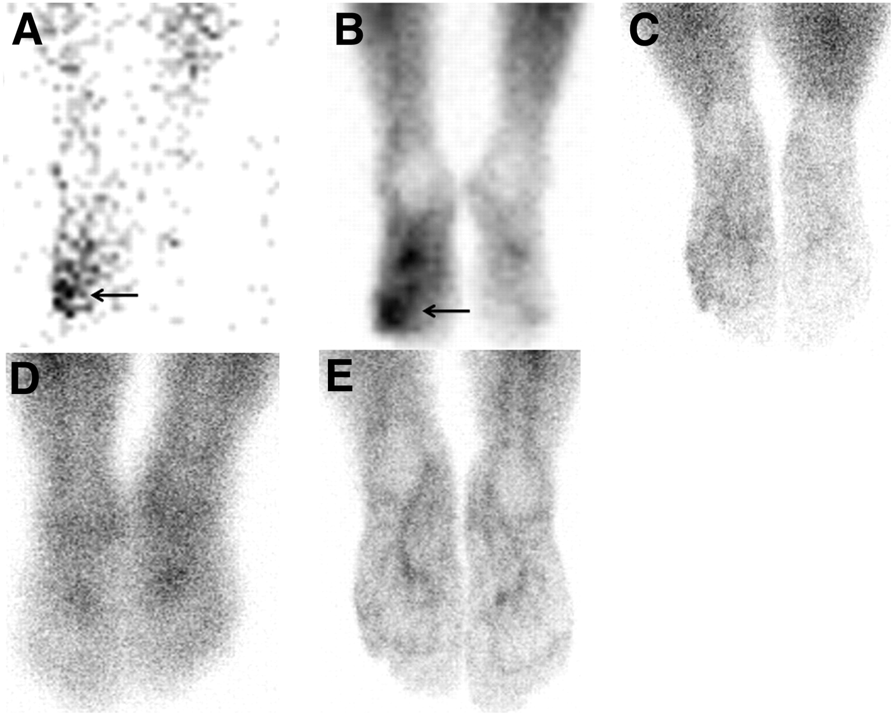 The Diagnostic Value Of 99mtc Igg Scintigraphy In The Diabetic Foot And